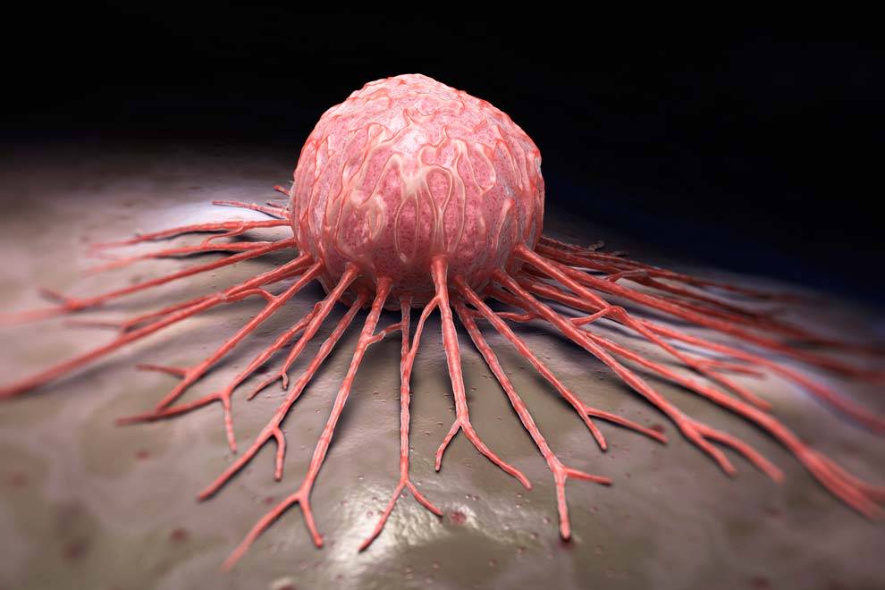 Pacientes con mieloma múltiple con doble riesgo de contagiarse de covid