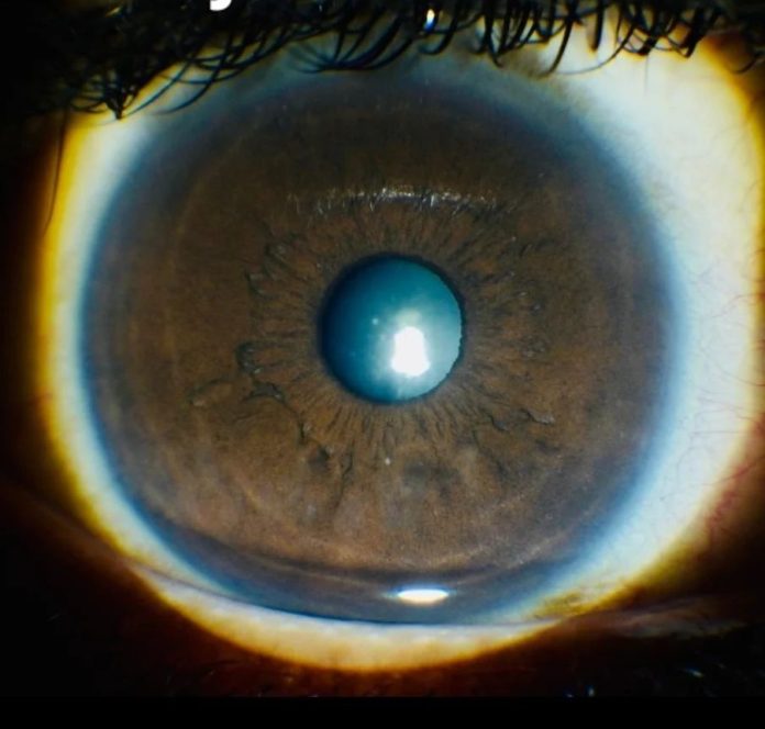 ¿En qué consiste la despigmentación del iris con láser?